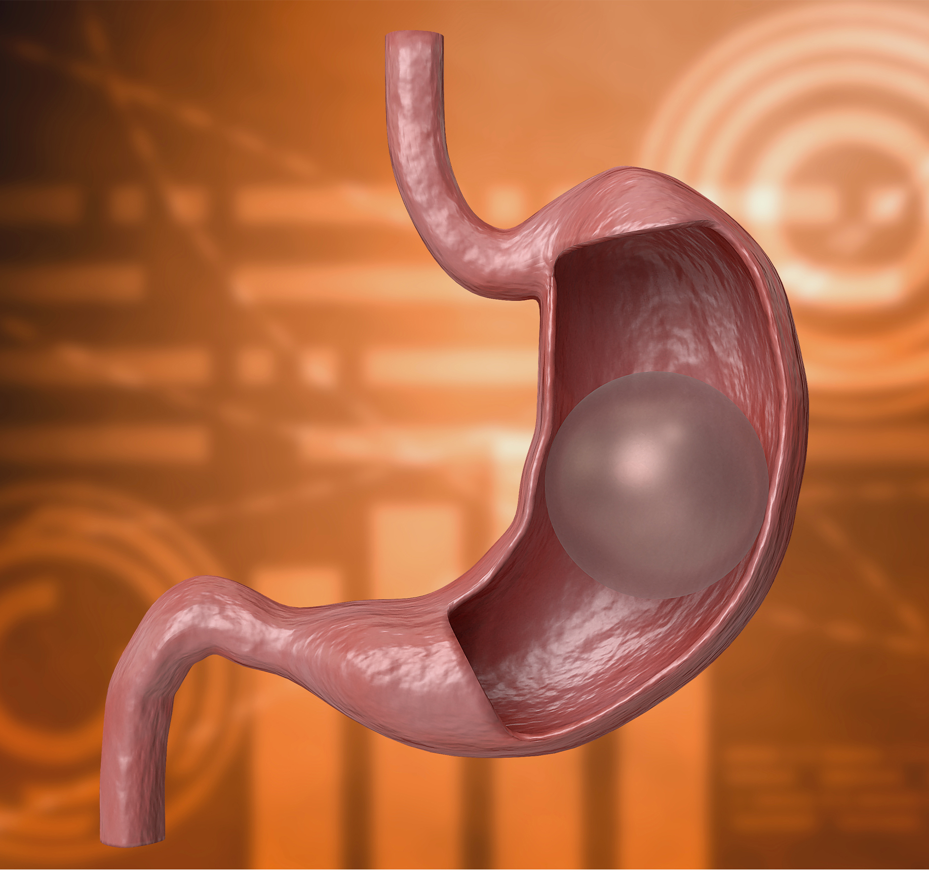 Orbera Gastric Balloon – Weight Loss Surgery Center in Northwest ...